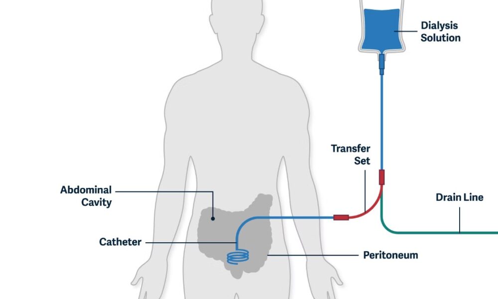 Is Peritoneal Dialysis Superior to Traditional Hemodialysis for People ...